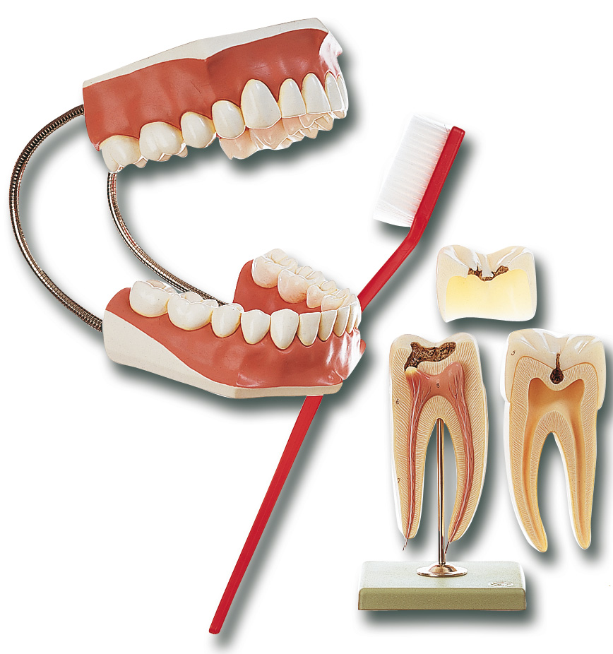 Backenzahn mit Karies, Es 8 | LMS Lehrmittel-Service H.Späth GmbH